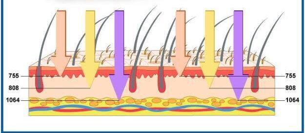 VELVET ICE TRI-WAVE LASER | Beauty Through Technology